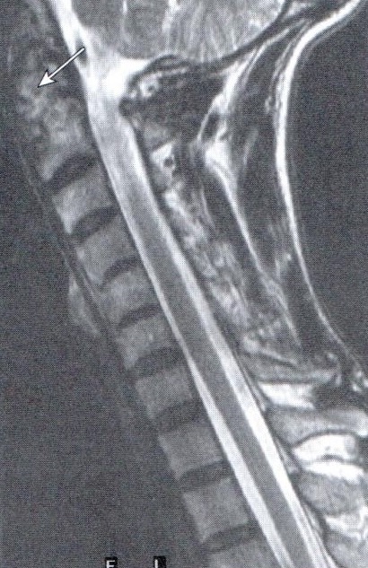 Inflammatory Arthropathies and Increased ADI - Illinois Chiropractic ...
