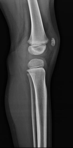 The MRI Appearance and Significance of the Popliteal Cyst - Illinois ...